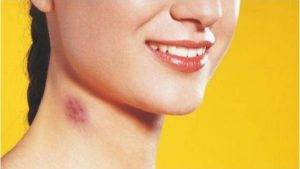 ¿Cómo quitar un chupetón? Trucos y remedios caseros para ocultarlo por ...