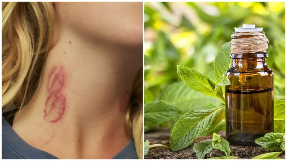 ¿Cómo quitar un chupetón? Trucos y remedios caseros para ocultarlo por ...